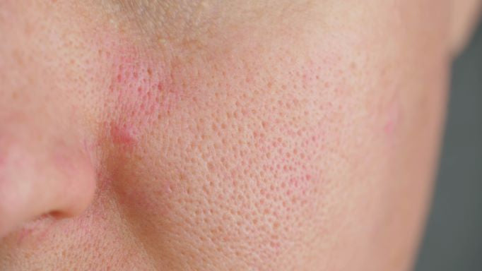 How To Deep Cleanse Facial Pores Open Formula