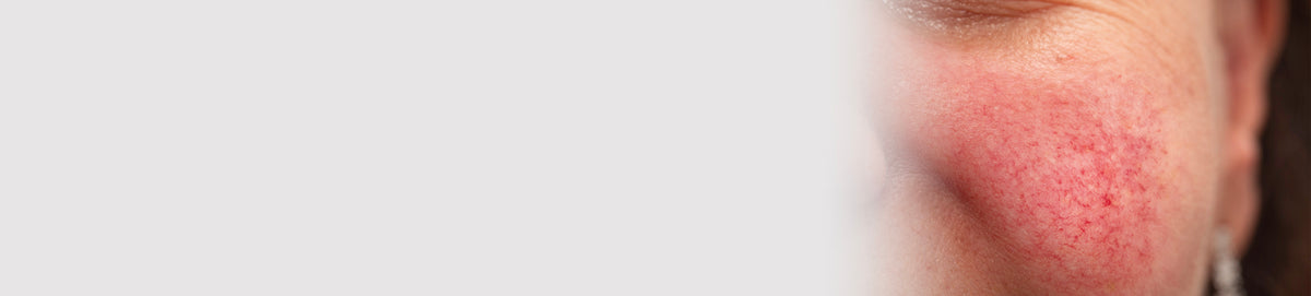 Rosacea – Open Formula